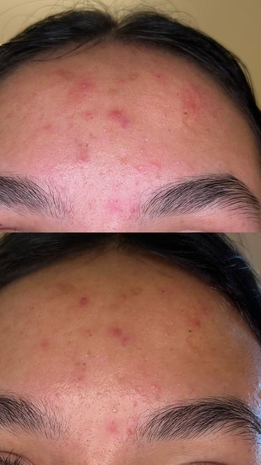 Pimple Paste | Overnight Spot Treatment for Breakouts – INNBEAUTY PROJECT