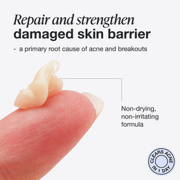 Acne Serum | Medicated Treatment for Acne & Blackhead Control ...