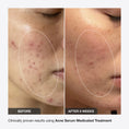 Acne Treatment Serum | Clears Breakouts & Blackheads – INNBEAUTY PROJECT