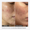 Acne Serum | Medicated Treatment for Acne & Blackhead Control ...