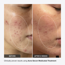 Acne Treatment Serum | Clears Breakouts & Blackheads – INNBEAUTY PROJECT