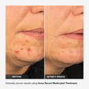 Acne Treatment Serum | Clears Breakouts & Blackheads – INNBEAUTY PROJECT