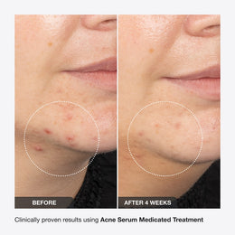 Acne Serum | Medicated Treatment for Acne & Blackhead Control ...