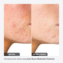 Acne Serum | Medicated Treatment for Acne & Blackhead Control ...
