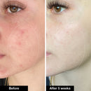 Acne Serum - FDA-approved, medicated Acne Serum with Salicylic Acid ...