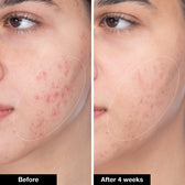 Acne Serum - FDA-approved, medicated Acne Serum with Salicylic Acid ...