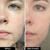 Acne Serum - FDA-approved, medicated Acne Serum with Salicylic Acid ...