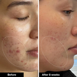 Acne Serum - FDA-approved, medicated Acne Serum with Salicylic Acid ...