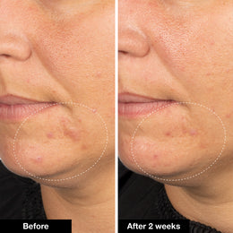 Acne Serum - FDA-approved, medicated Acne Serum with Salicylic Acid ...