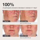 Calm The Red Down | Soothing Serum for Redness & Irritation – INNBEAUTY ...