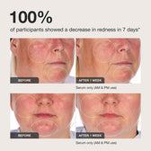 Calm The Red Down | Soothing Serum for Redness & Irritation – INNBEAUTY ...