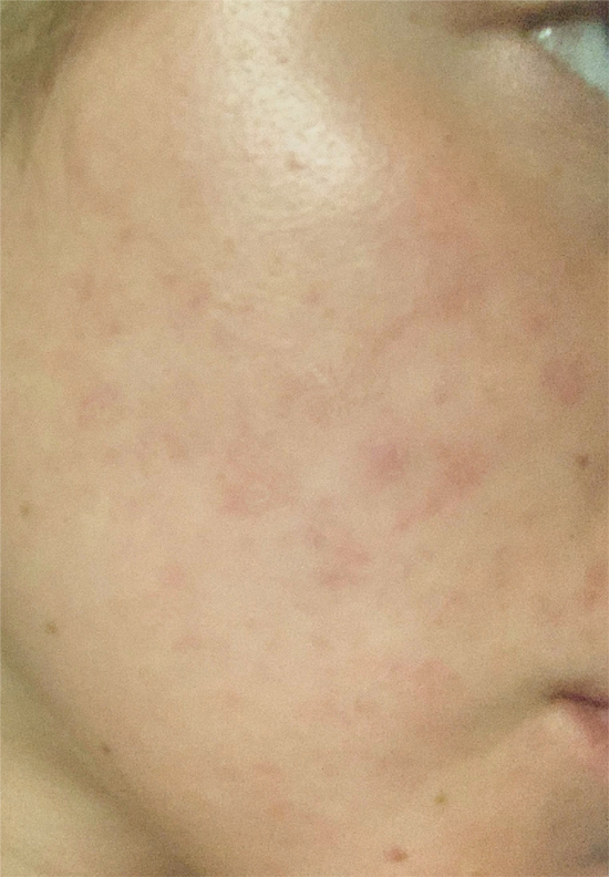 Pimple Paste – INNBEAUTY PROJECT