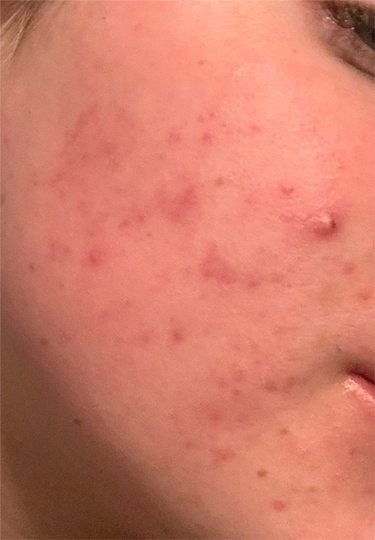 Pimple Paste – INNBEAUTY PROJECT