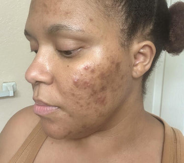 Pimple Paste | Overnight Spot Treatment for Breakouts – INNBEAUTY PROJECT