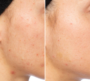 Pimple Paste | Overnight Spot Treatment for Breakouts – INNBEAUTY PROJECT