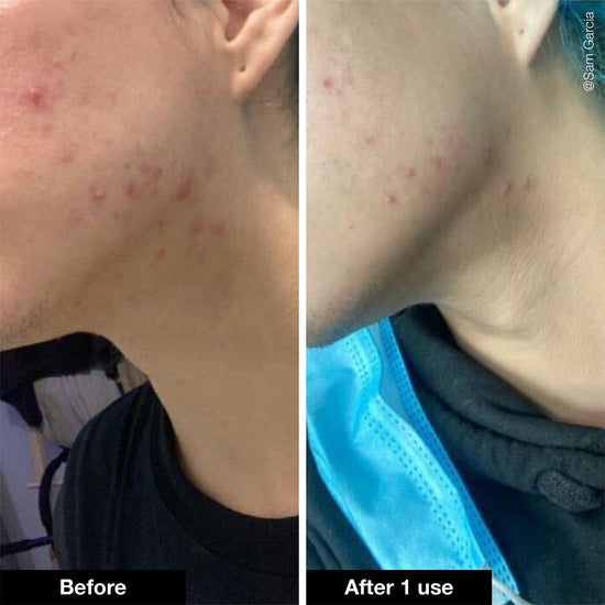 Pimple Paste – INNBEAUTY PROJECT