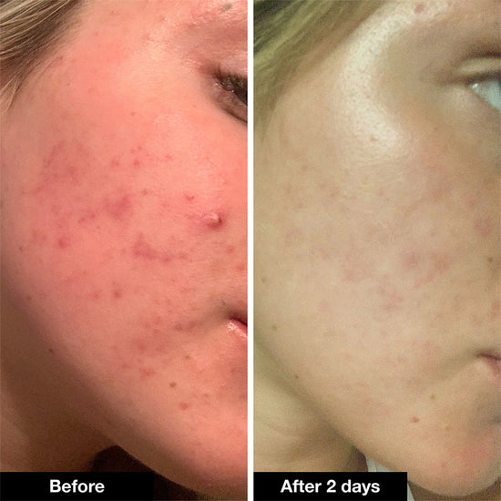 Pimple Paste | Overnight Spot Treatment for Breakouts – INNBEAUTY PROJECT